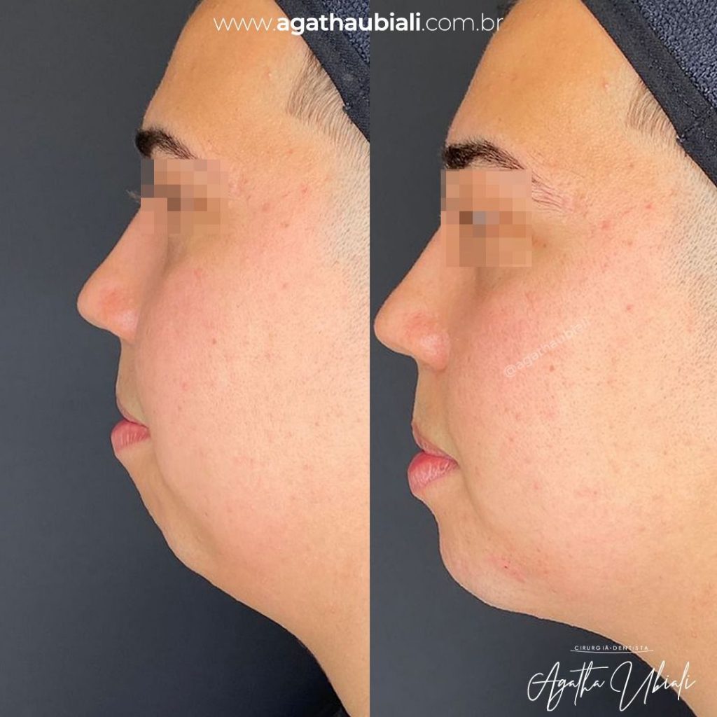 Preenchimento de mento (queixo) com 2mls de ácido hialurônico – Dra ...