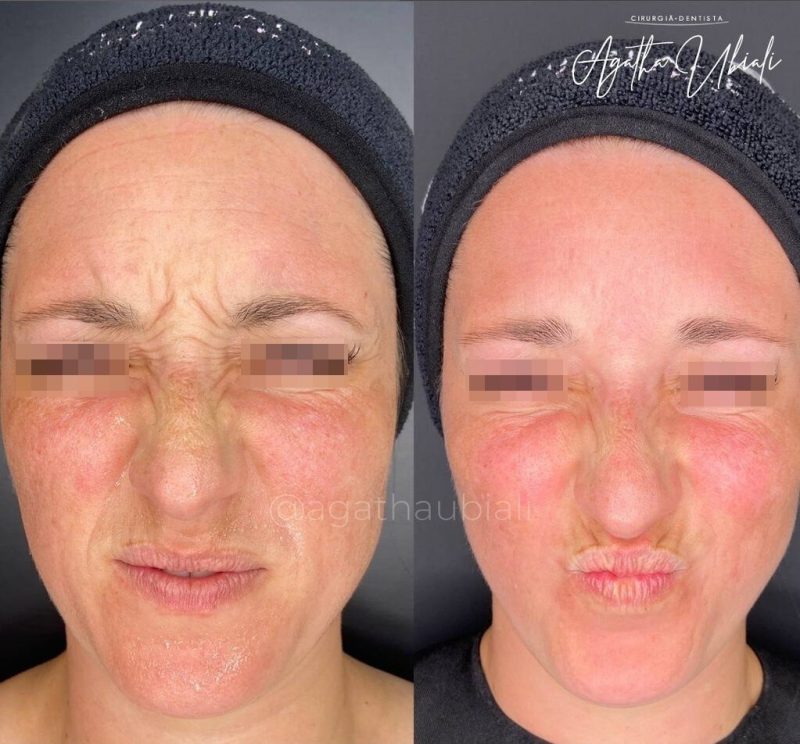 Aplicação de Toxina Botulínica na região do nariz – Dra Agatha Ubiali