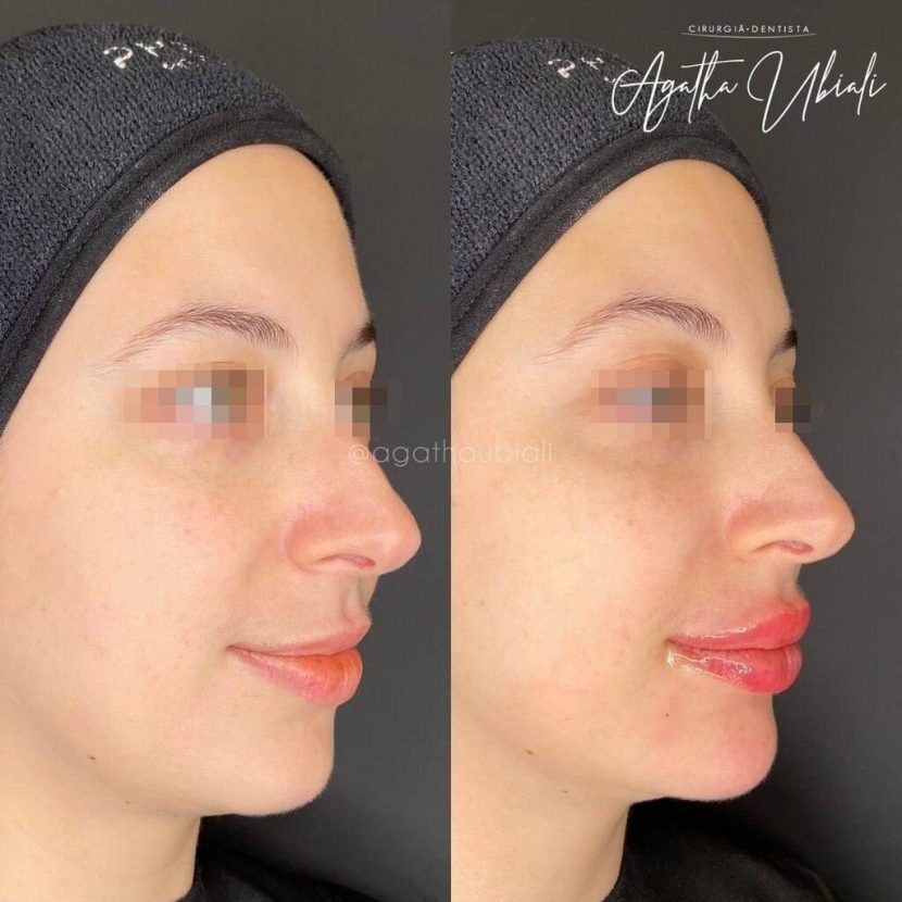 Preenchimento labial (1ml) e mento (2mls) – Dra Agatha Ubiali